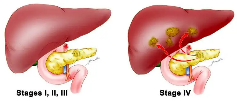 Stage 4 Pancreatic Cancer Life Expectancy 2026 - Stagescancer.net