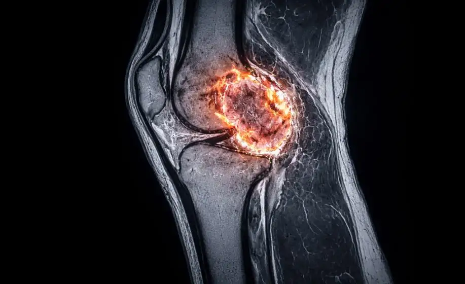 MRI of Bone Cancer: Importance, Procedure, Accuracy, and Role in ...