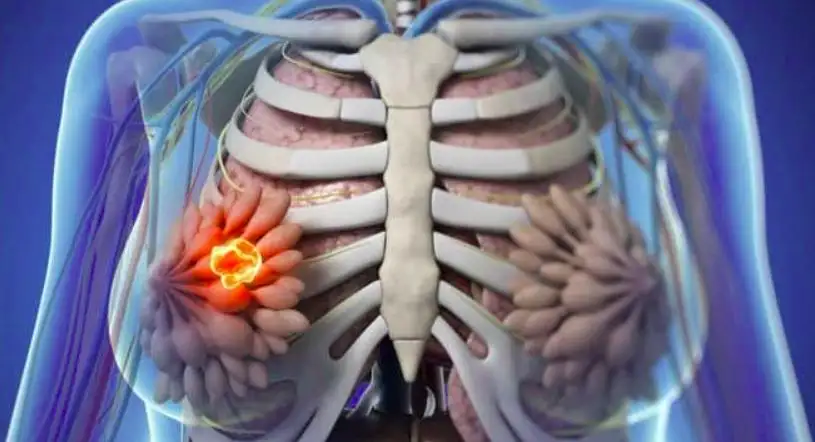 The Dangers of Breast Cancer: Risks, Symptoms, Treatment, and ...